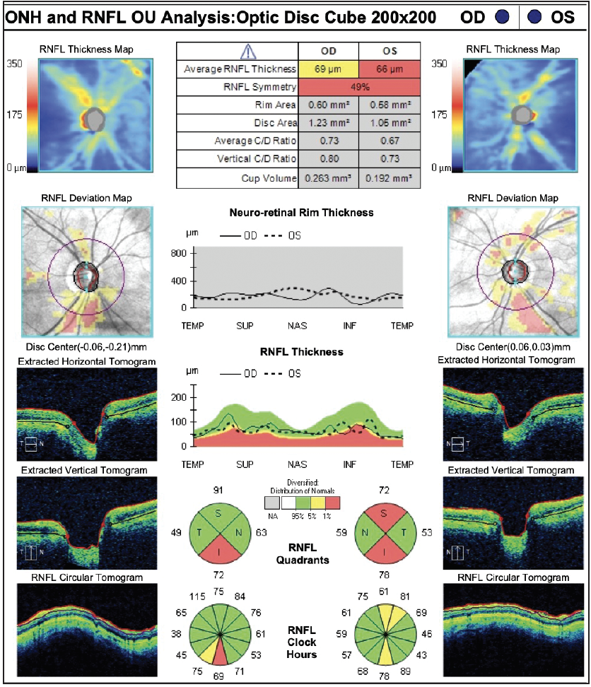 Recurrent Hyphema - Glaucoma Today