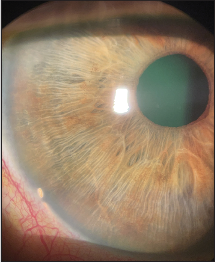 Recurrent Hyphema - Glaucoma Today