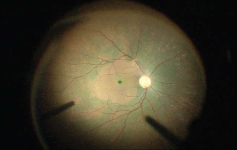 Surgical Repair of Persistent Macular Hole After Wide ILM Peel - Retina ...