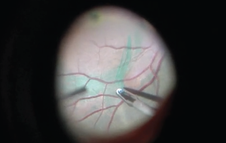 Surgical Repair of Persistent Macular Hole After Wide ILM Peel - Retina ...