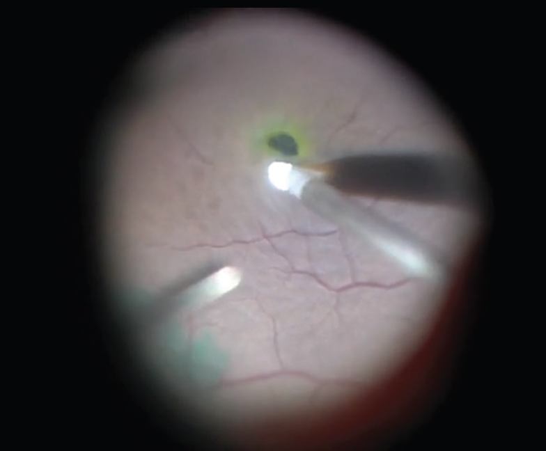 Surgical Repair of Persistent Macular Hole After Wide ILM Peel - Retina ...