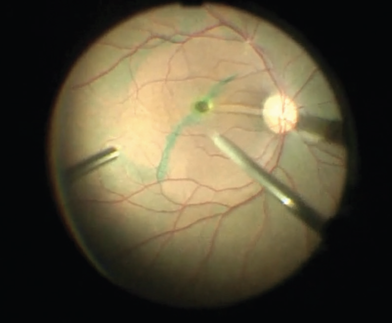 Surgical Repair of Persistent Macular Hole After Wide ILM Peel - Retina ...
