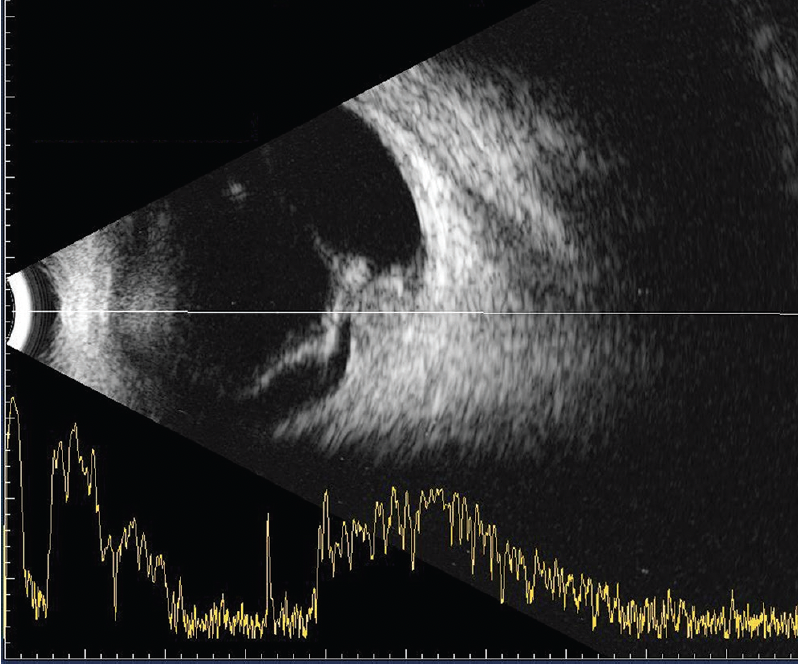 Complex Repair of Combined Tractional/ Rhegmatogenous Retinal ...