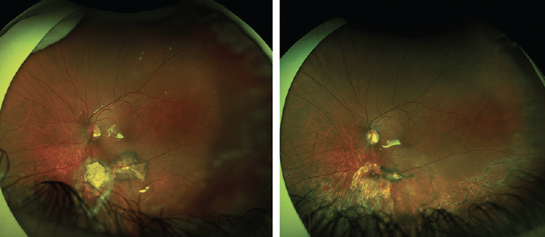 Complex Repair of Combined Tractional/ Rhegmatogenous Retinal ...