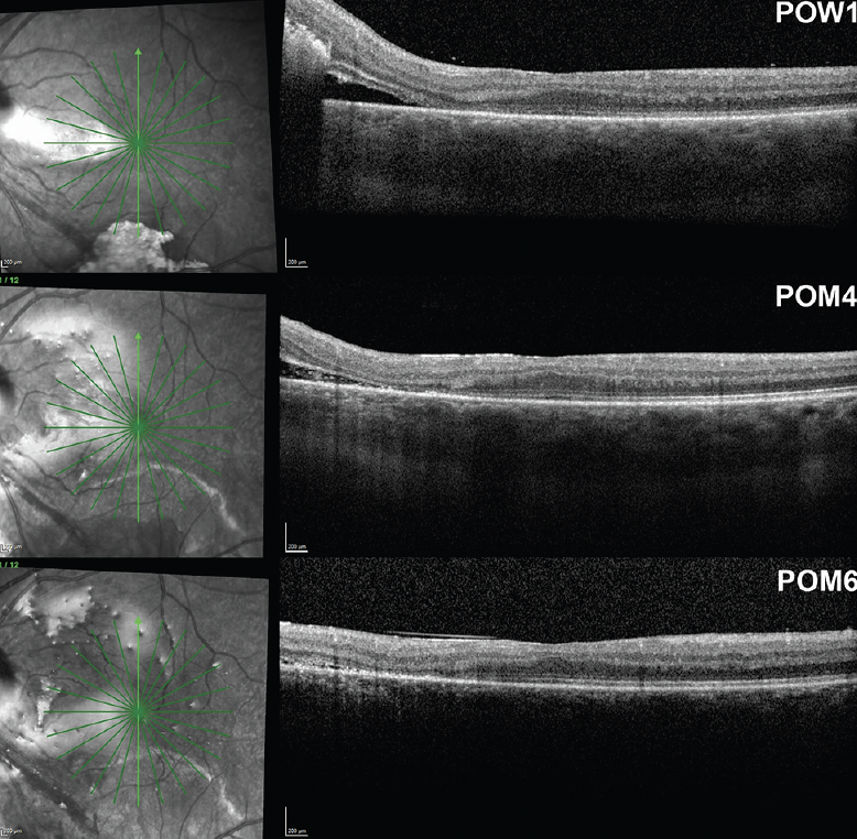 Complex Repair of Combined Tractional/ Rhegmatogenous Retinal ...