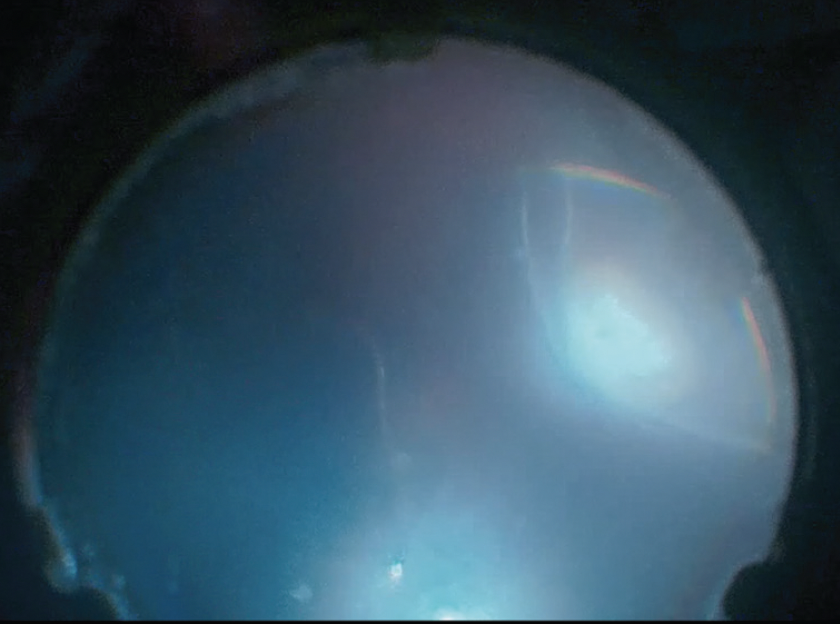 Scleral Buckle Placement Using Chandelier Illumination for a Macula ...