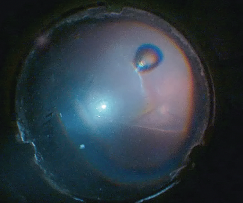 Scleral Buckle Placement Using Chandelier Illumination for a Macula ...