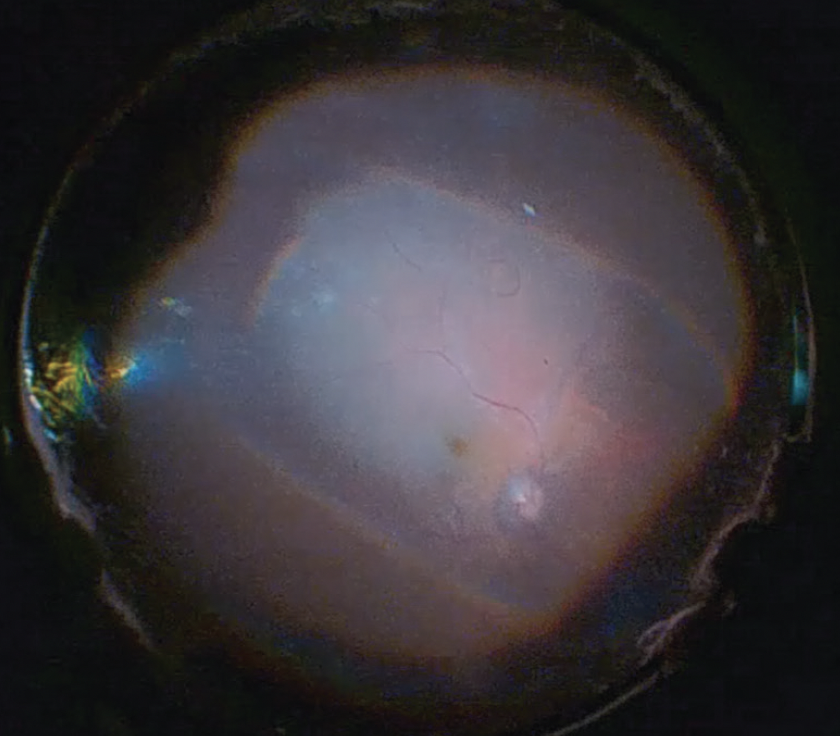 Scleral Buckle Placement Using Chandelier Illumination for a Macula ...