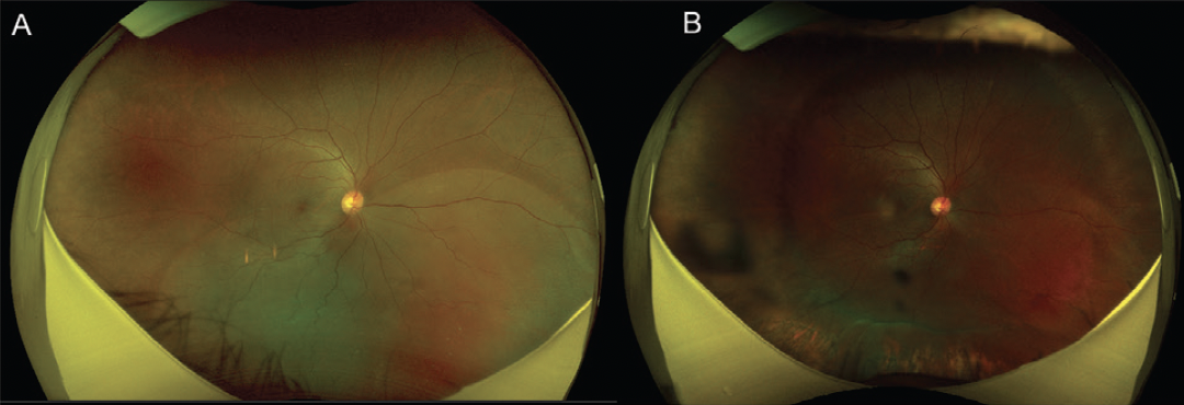Scleral Buckle Placement Using Chandelier Illumination for a Macula ...