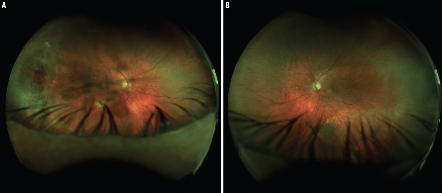Watch For Retinal Findings With Systemic Pazopanib - Retina Today