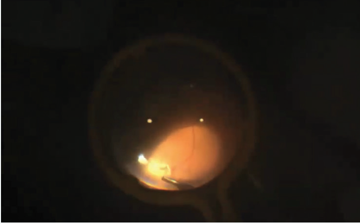 Vitreous Opacities - Retina Today