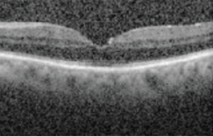 Vitreous Opacities - Retina Today
