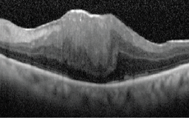 Vitreous Opacities - Retina Today
