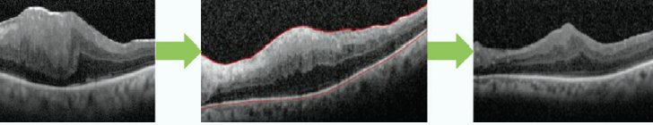 Vitreous Opacities - Retina Today