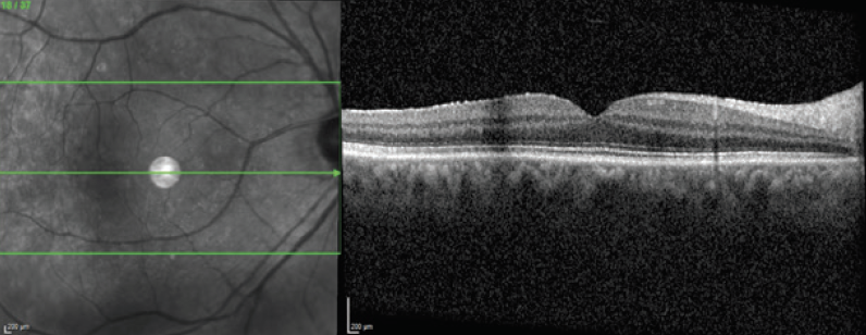Vitreous Opacities - Retina Today