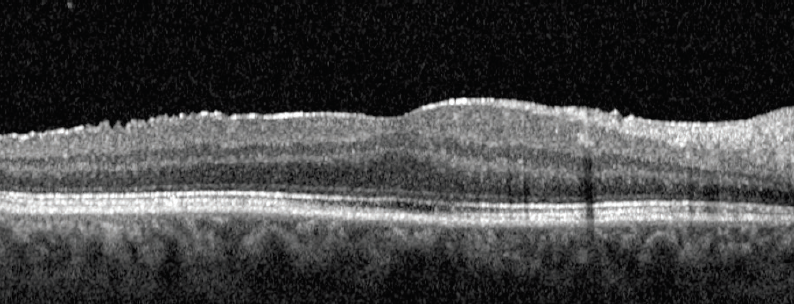 Vitreous Opacities - Retina Today