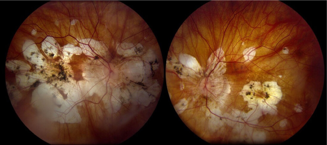 Collaborative Case #002: High and Dry - Modern Optometry