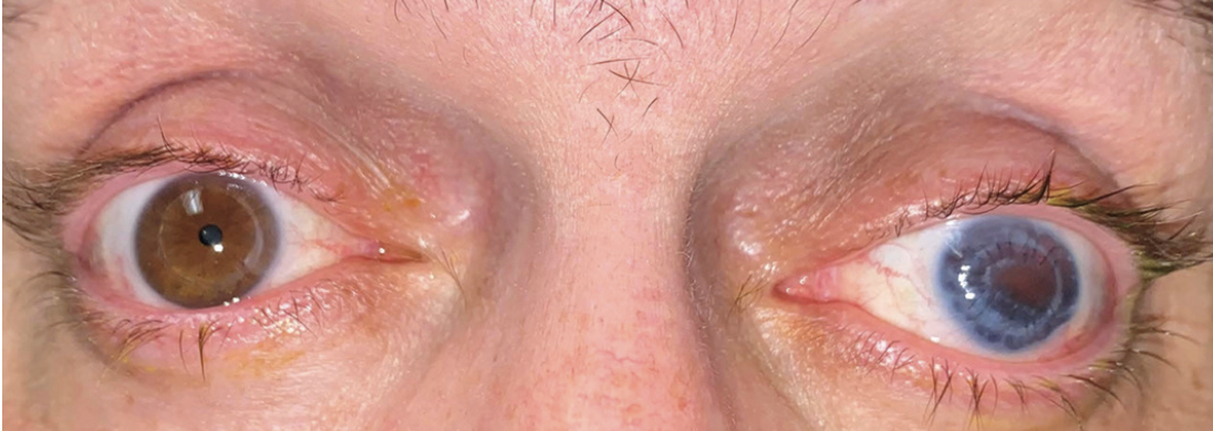 Mastering the Complexities of Cornea Care - YoungMD Connect