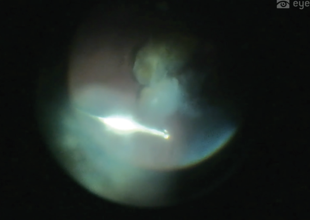 Hypersonic Vitrectomy—The Simple to the Complex - Retina Today