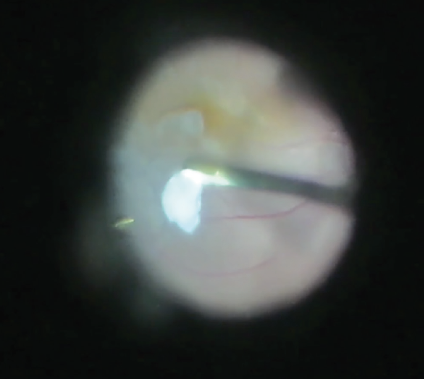 Hypersonic Vitrectomy—The Simple to the Complex - Retina Today