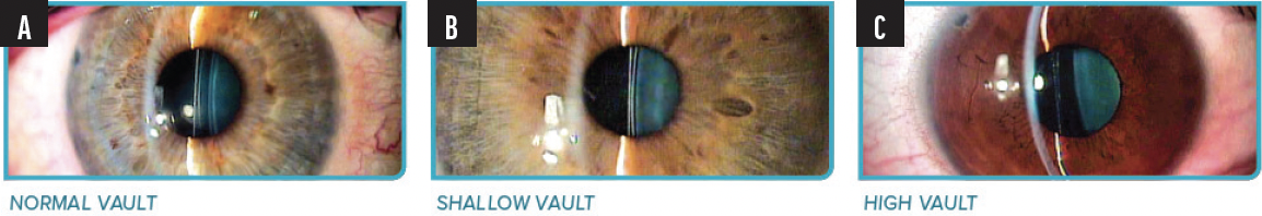 Phakic IOL Surgery - YoungMD Connect
