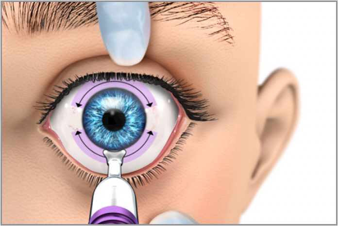 Comprehensive Ophthalmologists Discuss Practice Benefits of Transscleral Laser Therapy (TLT ...