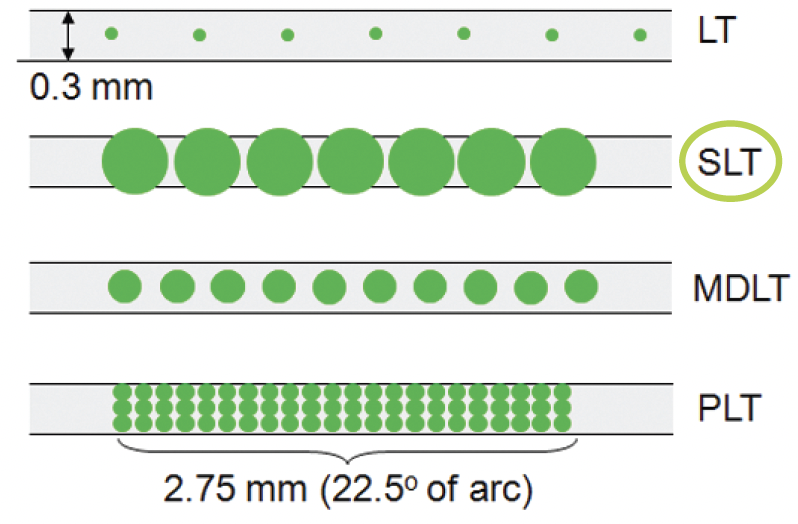 SLT: Positive Implications From the LiGHT Study - Glaucoma Today