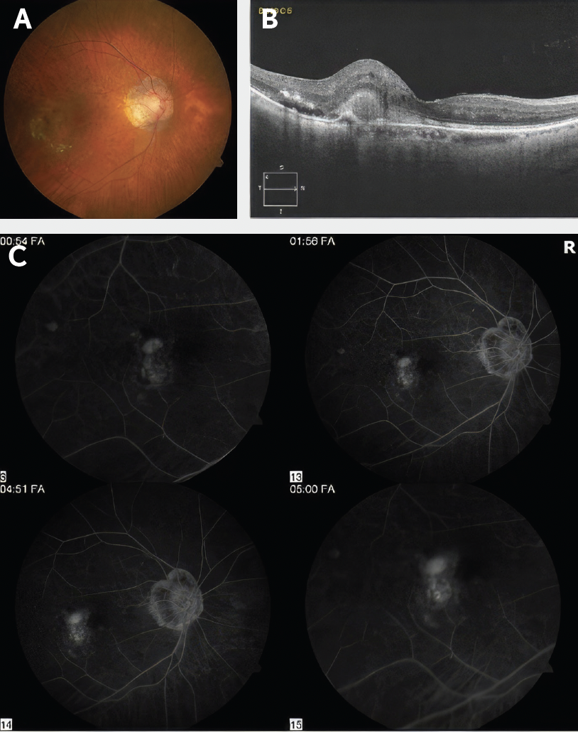 Management of Predominantly Classic Choroidal Neovascularization Due to ...