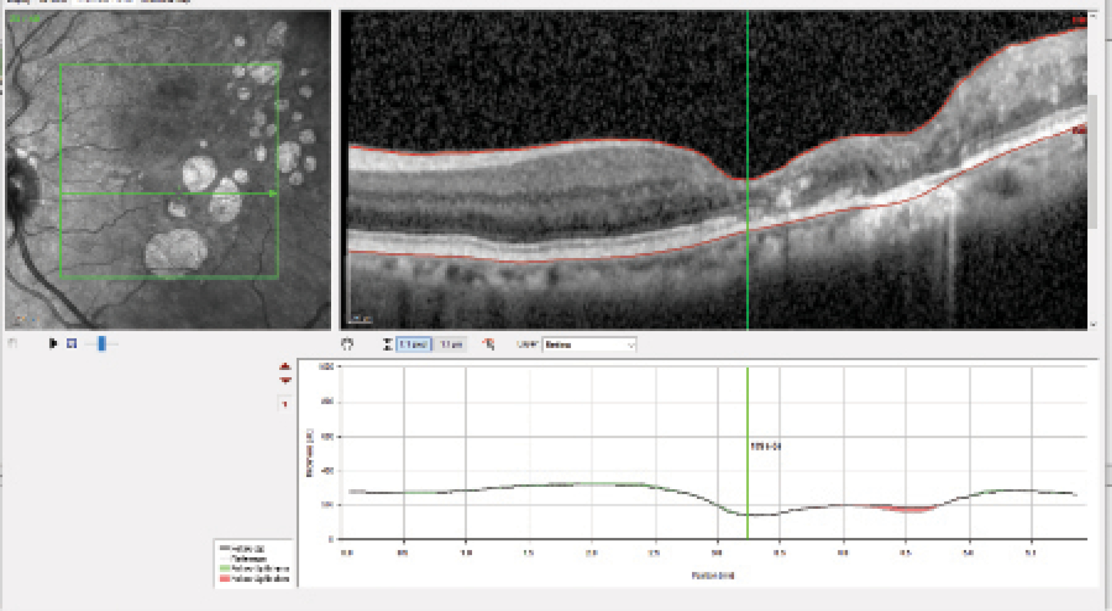 Shifting Paradigms in Glaucoma and GA - Glaucoma Today