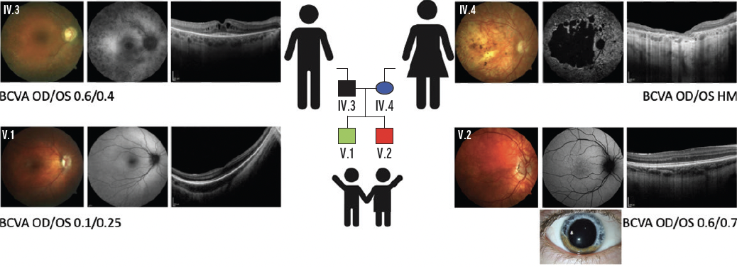 Fundamentals of the Diagnosis and Management of Inherited Retinal ...