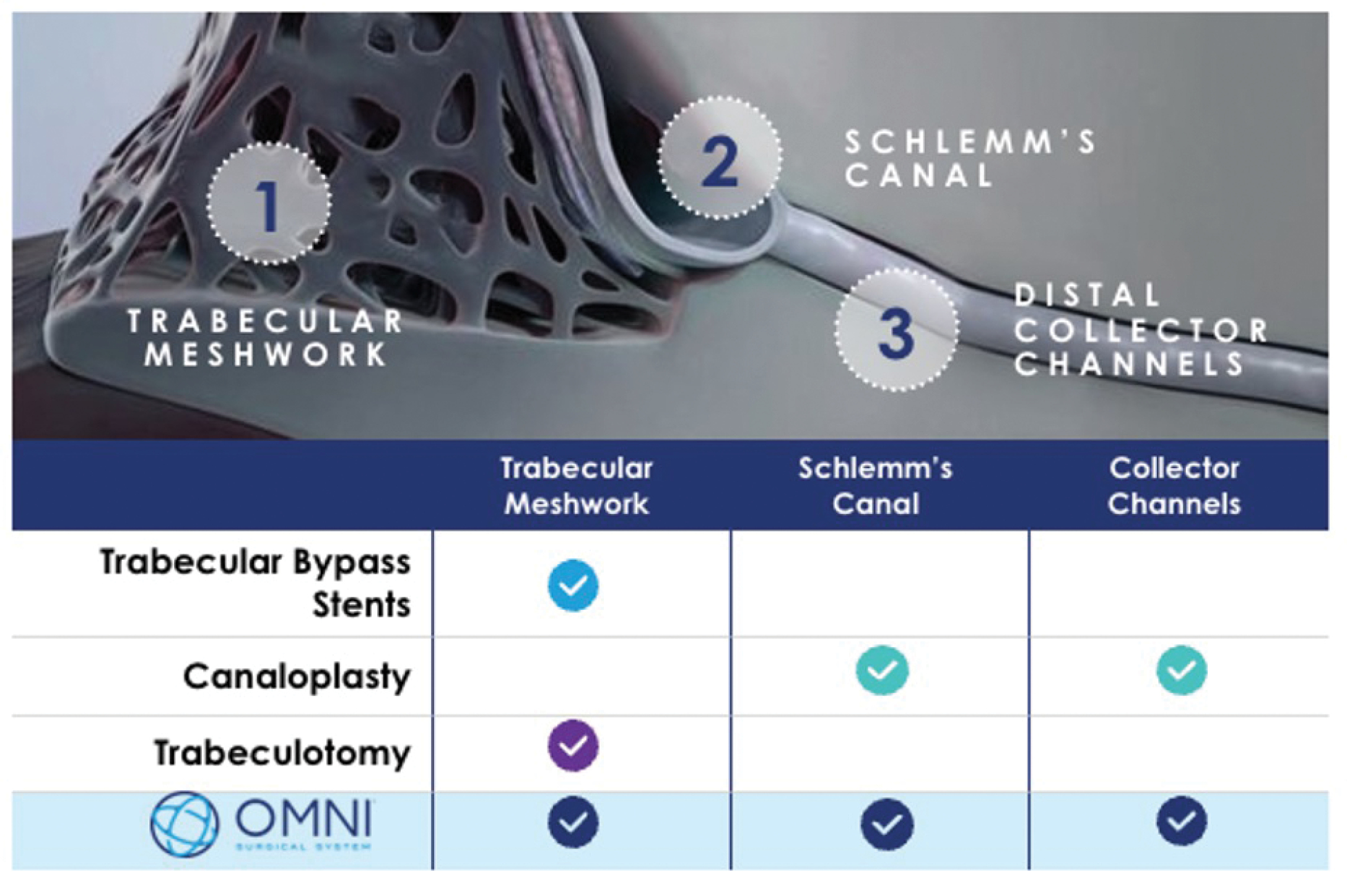 Nine Reasons Why We Perform MIGS with OMNI - Glaucoma Today