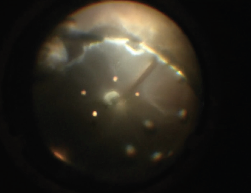 Vitrectomy for Rhegmatogenous Retinal Detachment Secondary to Acute ...