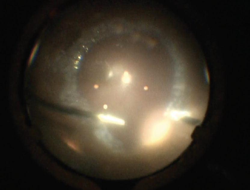 Vitrectomy for Rhegmatogenous Retinal Detachment Secondary to Acute ...