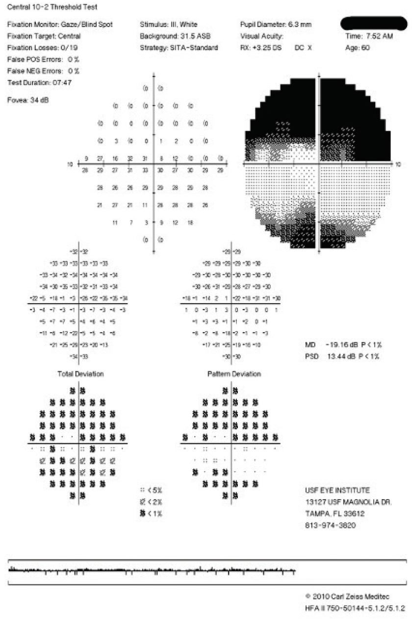 When Blebs Fail - Glaucoma Today