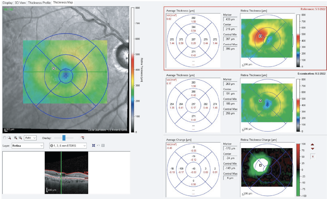 The Clinical and Economic Argument for MicroPulse® Laser in a Retinal ...