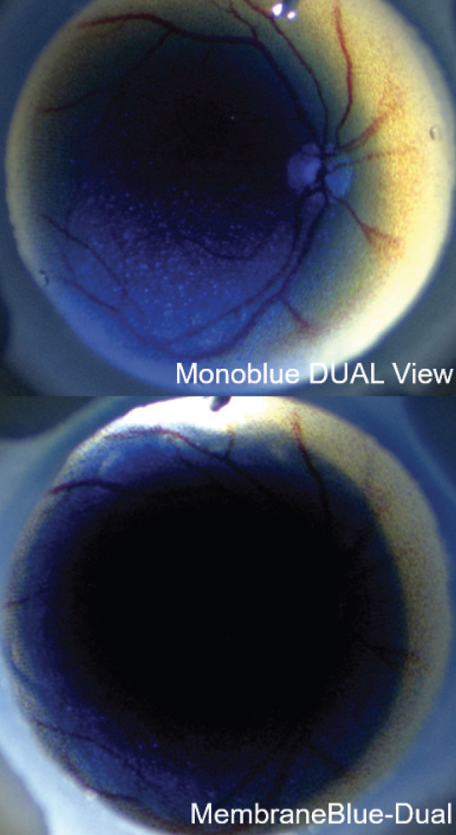 BVI Monoblue DUAL View and ILM View: Novel Appealing Staining Solutions ...