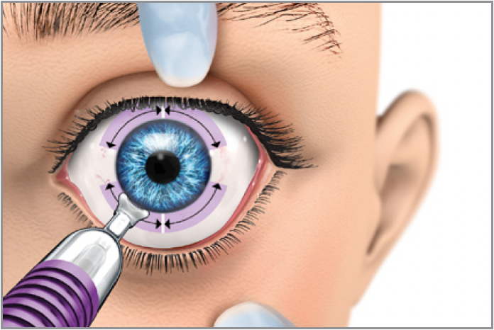 Comprehensive Ophthalmologists Discuss Practice Benefits of Transscleral Laser Therapy (TLT ...