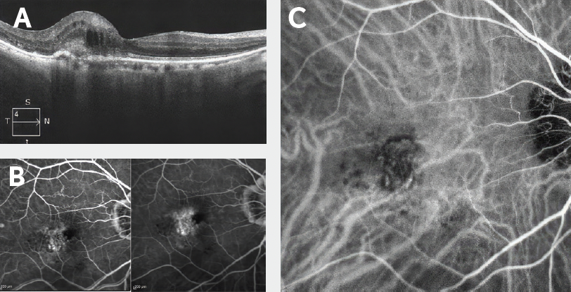 Management of Predominantly Classic Choroidal Neovascularization Due to ...