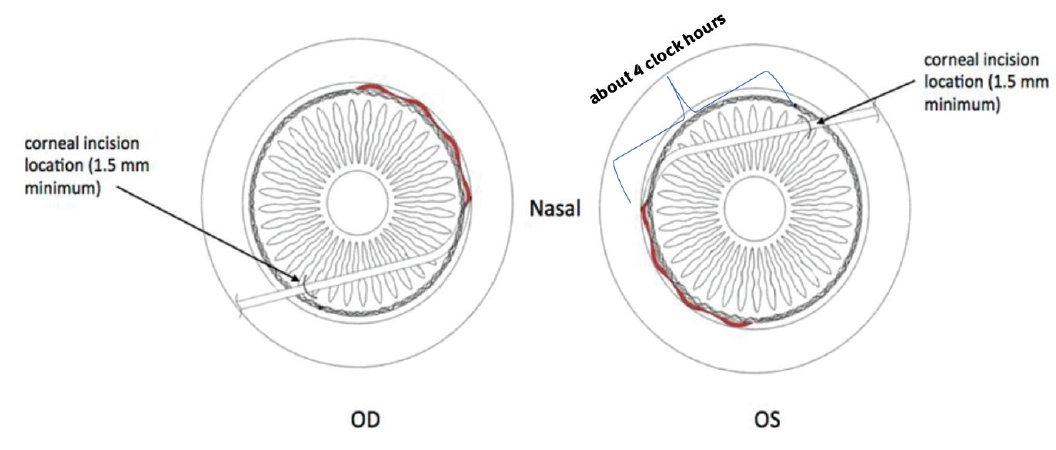 Insertion Pearls for The HYDRUS Microstent - Glaucoma Today