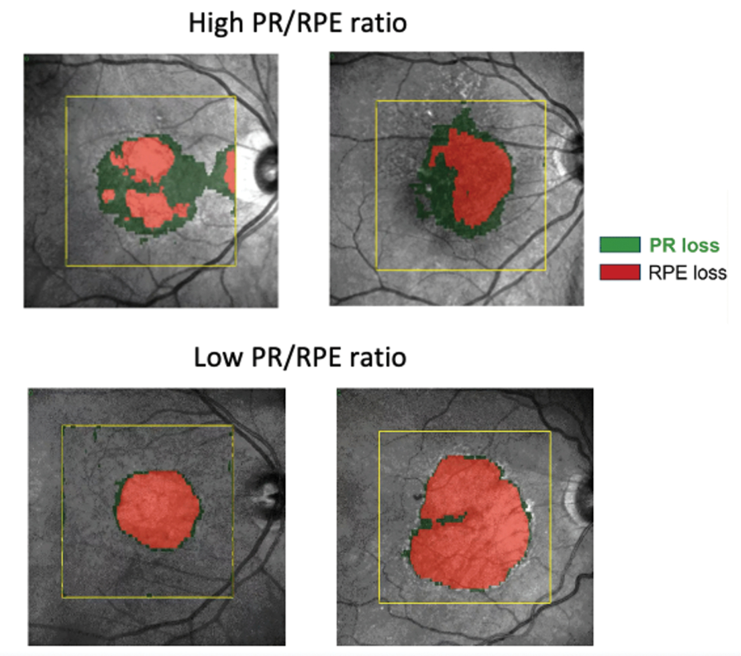 Developing Outcome Targets for Geographic Atrophy Treatment - Retina Today