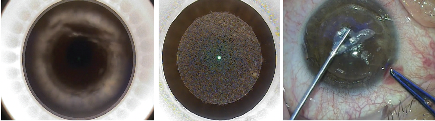 Mastering the Complexities of Cornea Care - YoungMD Connect