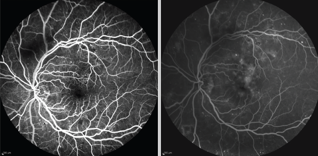 The Clinical and Economic Argument for MicroPulse® Laser in a Retinal ...