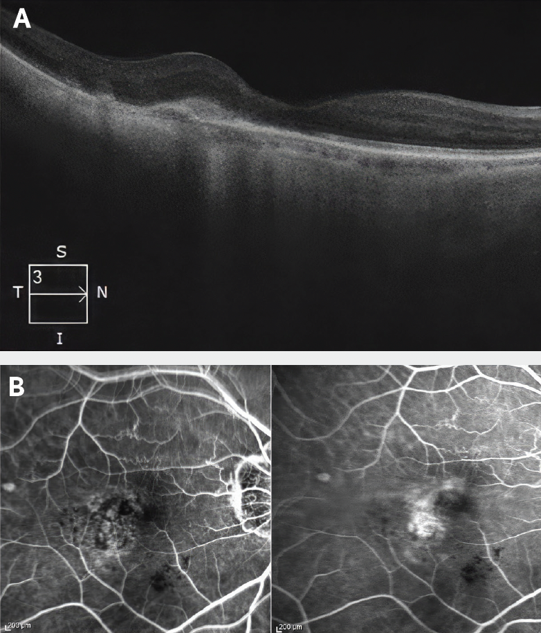 Management of Predominantly Classic Choroidal Neovascularization Due to ...