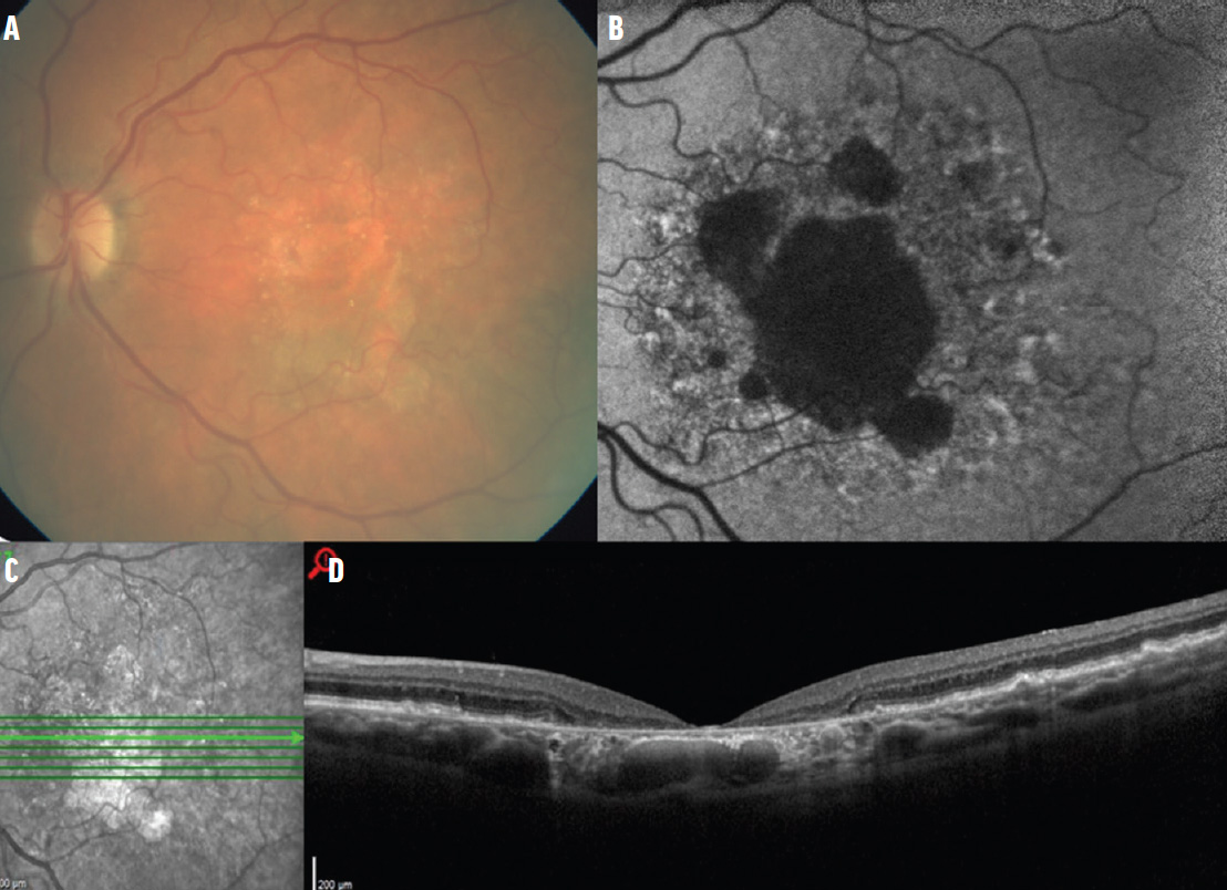 The Evolving Treatment Paradigm in Geographic Atrophy - Retina Today