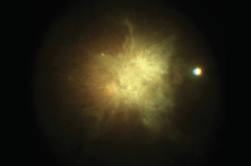 Viscodissection in Severe Diabetic Tractional Retinal Detachments ...