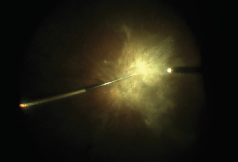 Viscodissection in Severe Diabetic Tractional Retinal Detachments ...