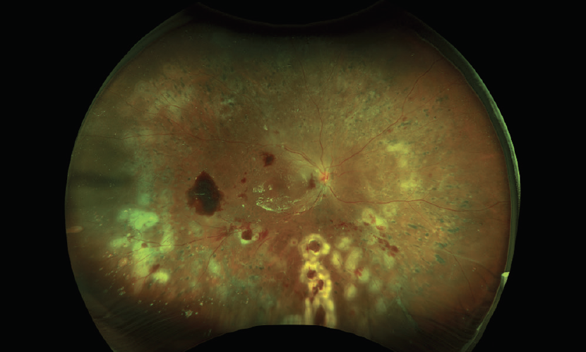 Viscodissection in Severe Diabetic Tractional Retinal Detachments ...