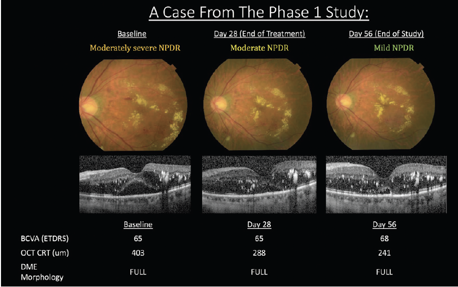 NPDR Practice Patterns in Real-World Practice - Retina Today