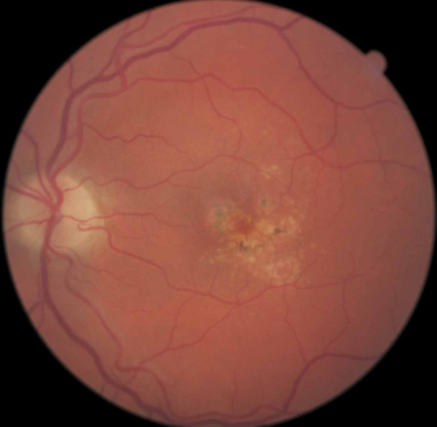 Collaborative Case #004: The Elephant in the Room - Modern Optometry