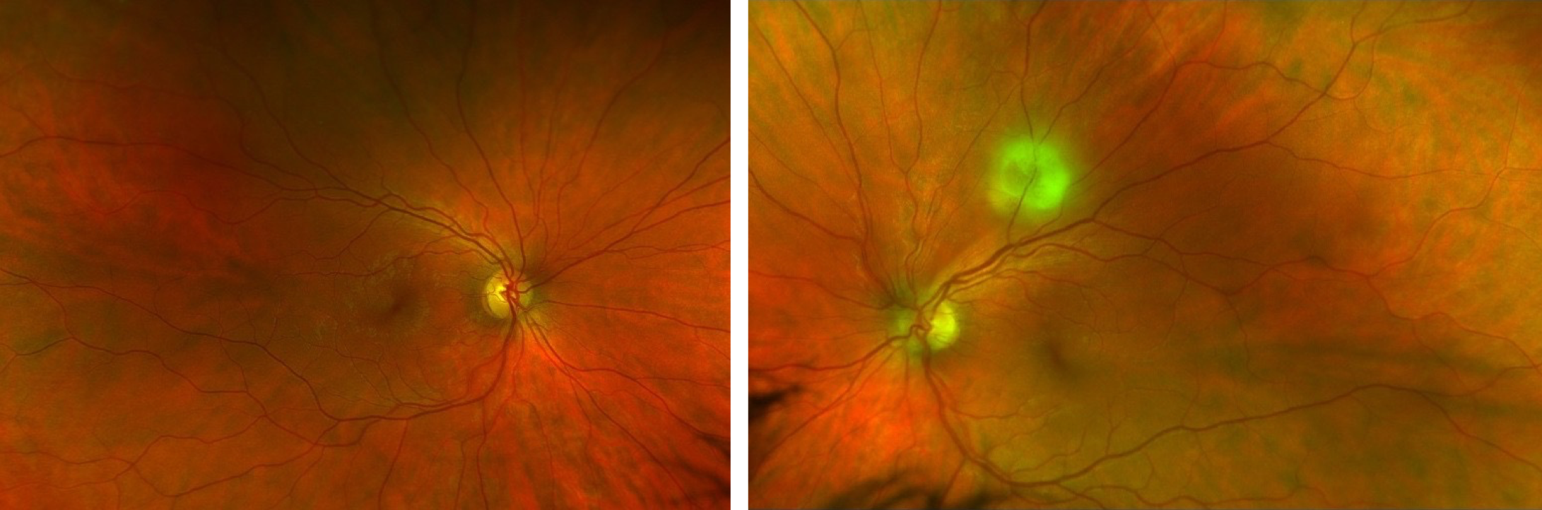 Collaborative Case #005: Things that Bug the Retina - Modern Optometry